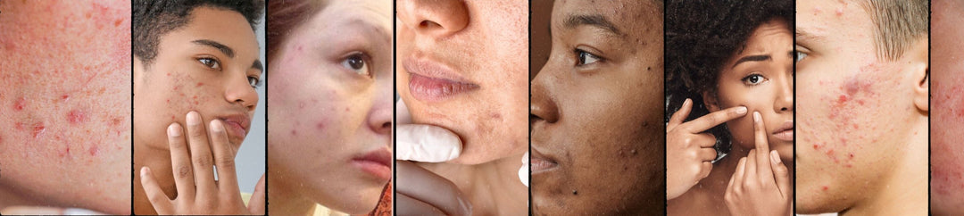 ACNE EDUCATION – Sweet LeiLani